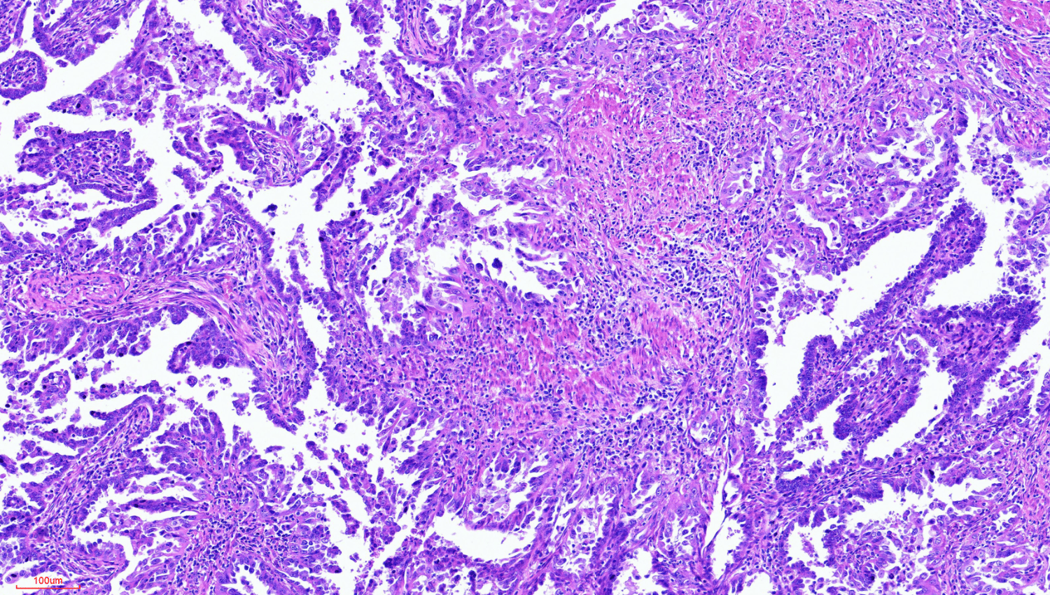 Cervical Tumour Tissue Microarray - MYmAb Biologics